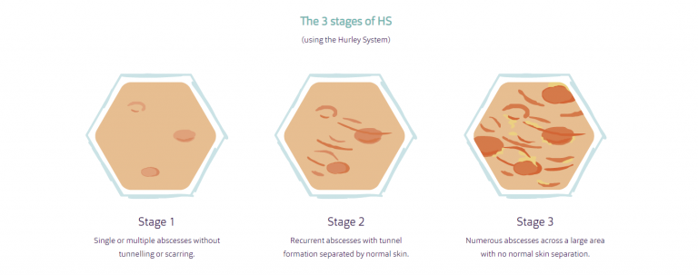 Hidradenitis Suppurativa Stages - HidraWear