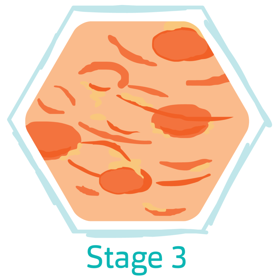 Hidradenitis Suppurativa Stages - HidraWear