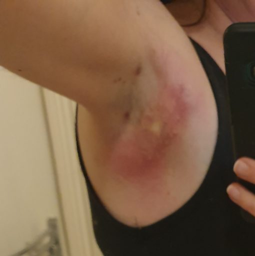 Pictures Of Hidradenitis Suppurativa - HidraWear