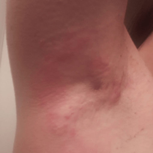 Pictures Of Hidradenitis Suppurativa - HidraWear
